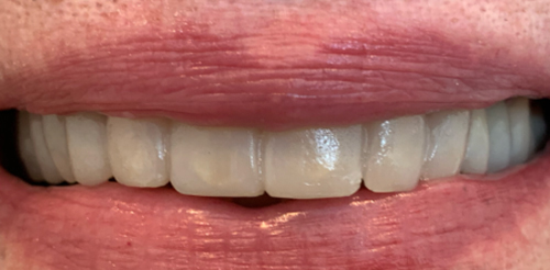 Before and After - Inna