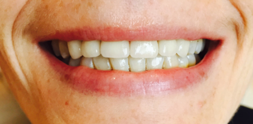 Before and After - Inna