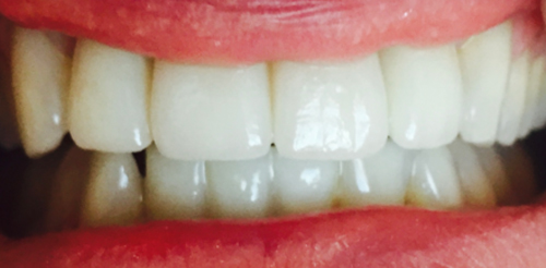 Before and After - Inna