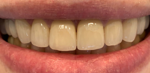 Before and After - Inna