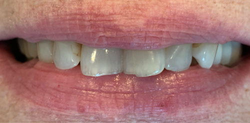 Before and After - Inna